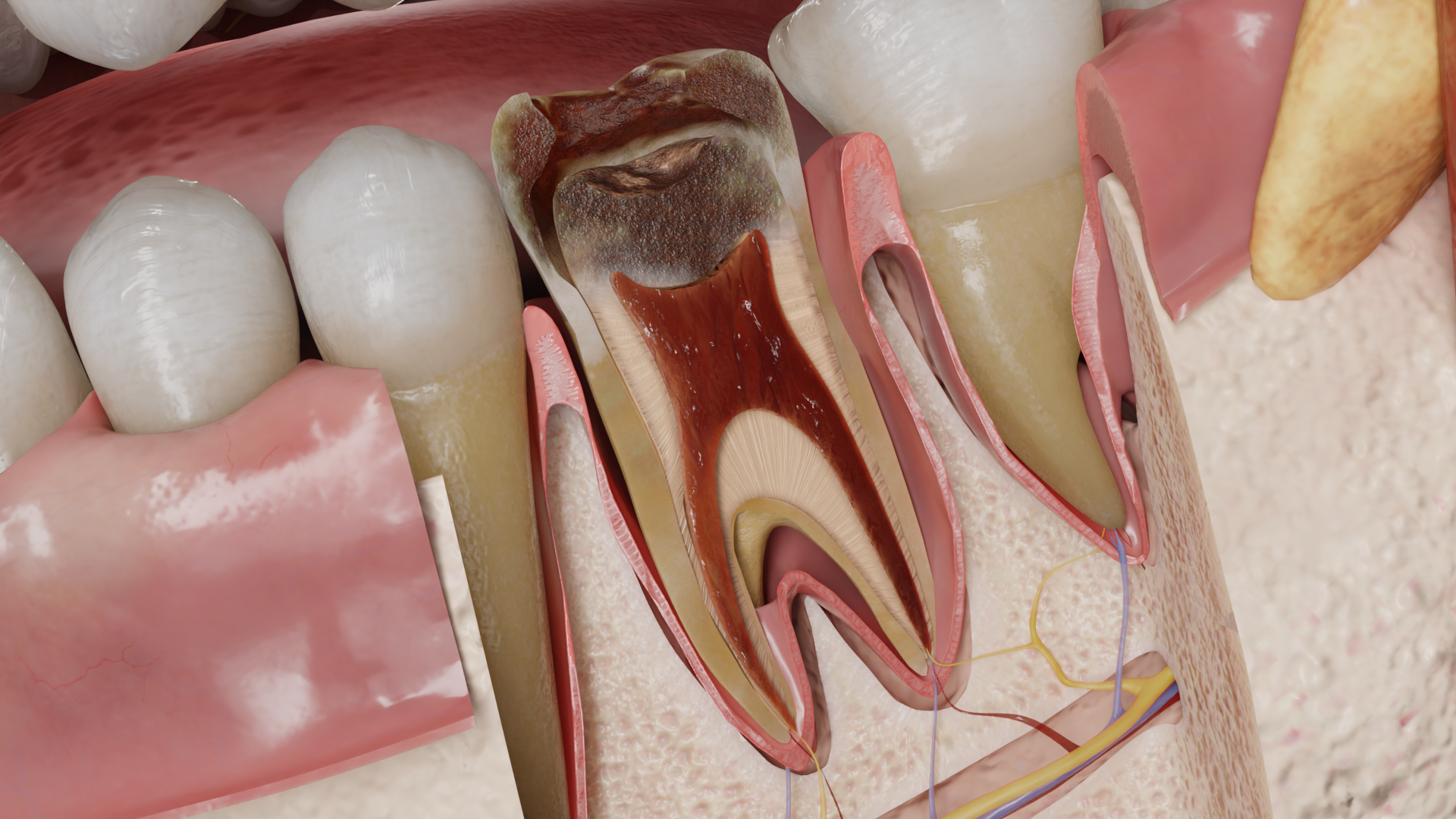 Irreversible Pulpitis: Etiology, Anatomy, Clinical Picture and Treatment